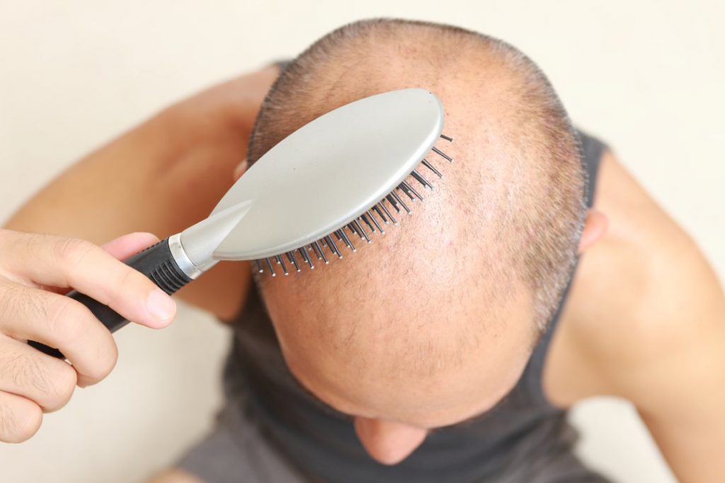 Alopecia Masculina | Perdida de Cabello | DHI Panamá